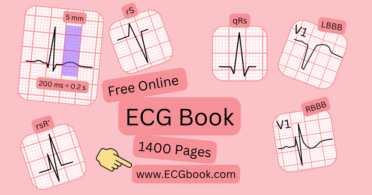 Arrhythmogenic Right Ventricular Dysplasia (ARVD) - ECG